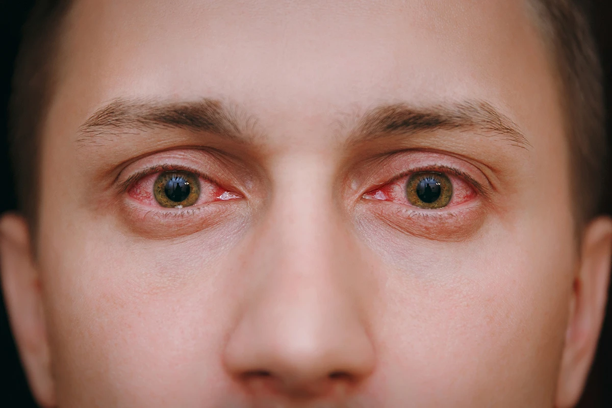 Pink Eye: Symptoms, Causes & Treatment